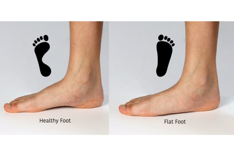 What Early Warning Signs Suggest Poor Foot Alignment? | The ...
